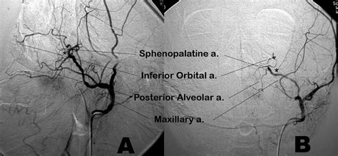 External Carotid Arteriogram From Anterior A And Lateral B Views Download Scientific