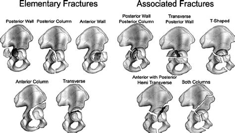 The Judet And Letournel Acetabular Fracture Classification System