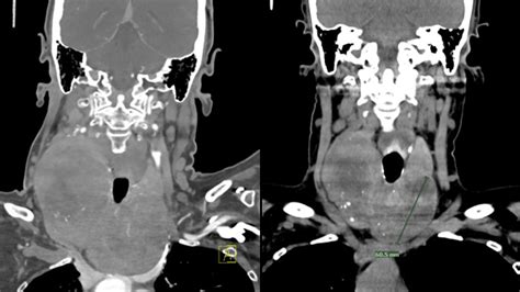 New Thyroid Artery Embolization Method Successfully Treats Large
