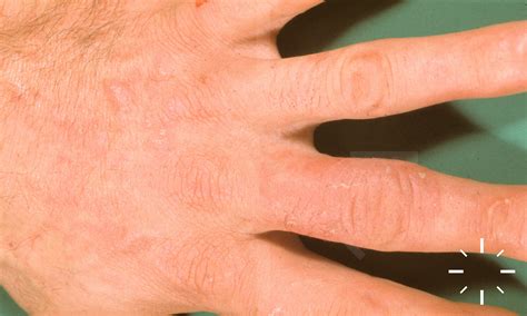 Dermacompass Erysipeloid