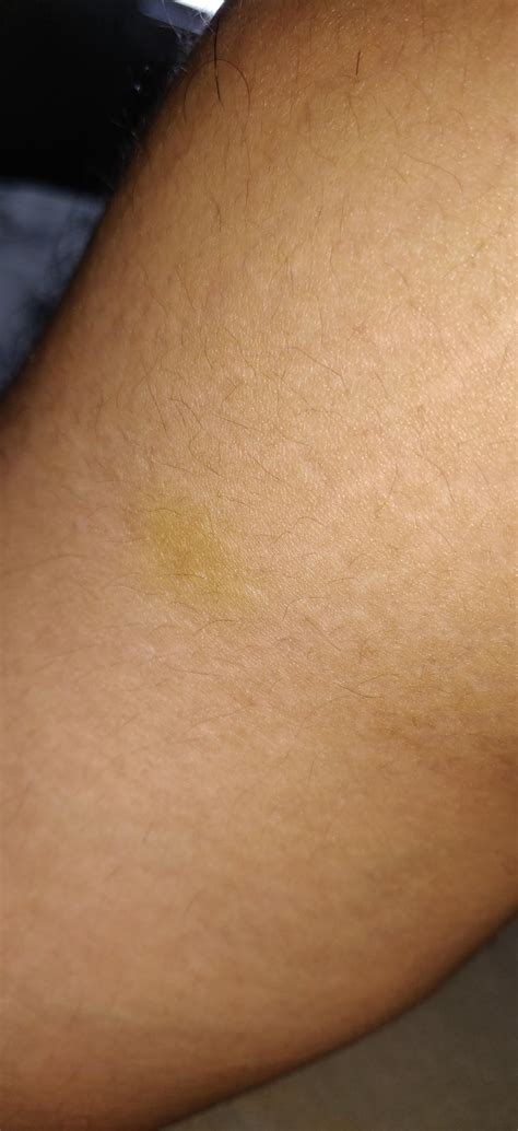 Yellow Spots On Either Biceps Sometimes Rdermatology