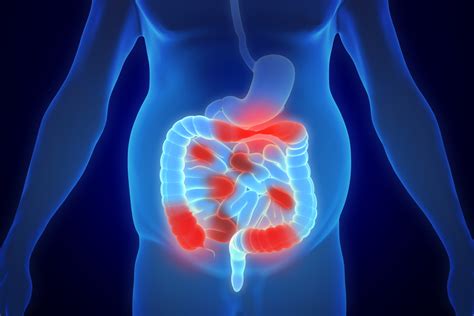 Crohns Disease Kingwood Gi Gastroenterology Clinic