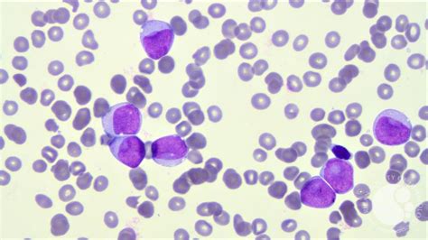 Aml With Npm1 And Flt3 Mutations