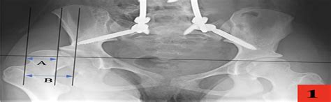 Pelvic Osteotomy In Patients With Previous Sacral Alar Iliac Journal Of Pediatric Orthopaedics
