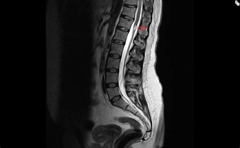 T2weighted Sagittal Mri Showing Spinal Cord Conus Spine