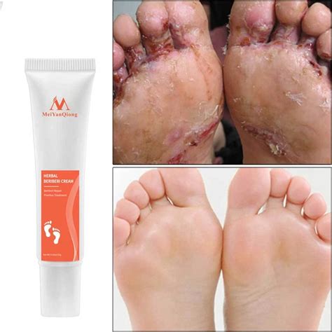 Fungal Infection On Foot Fingers Treatment Outlet