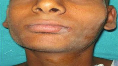 Unilateral Coronoid Hyperplasia Treated By Coronoidectomy Us