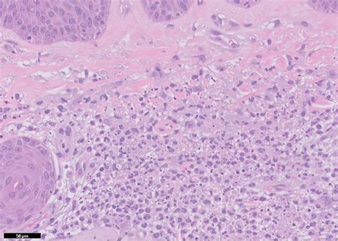 Case 1 Biopsy Of Lesion Showed Medium Vessel Vasculitis And Diffuse