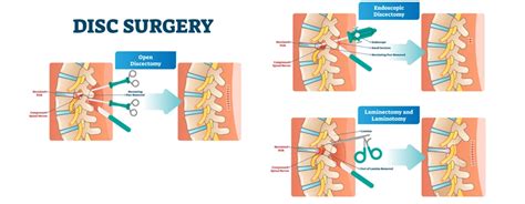 Discectomy Preparation Procedure And Recovery