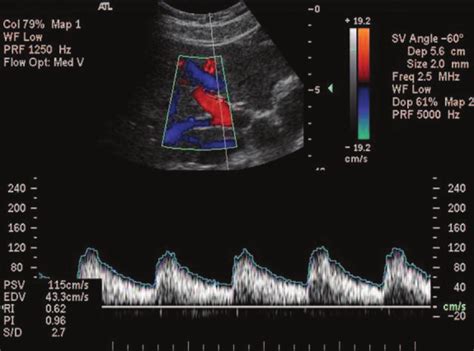 Normal Postoperative Duplex Doppler Us Image And Pulsed Doppler