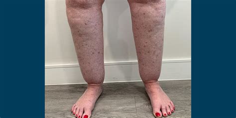 What Is Lipedema Lipedema Causes And Treatments Tactile Medical