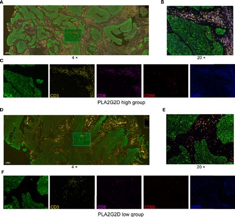 Mihc Staining For Cd3 Cd8 Cd68 Pck And Dapi In Cervical Squamous
