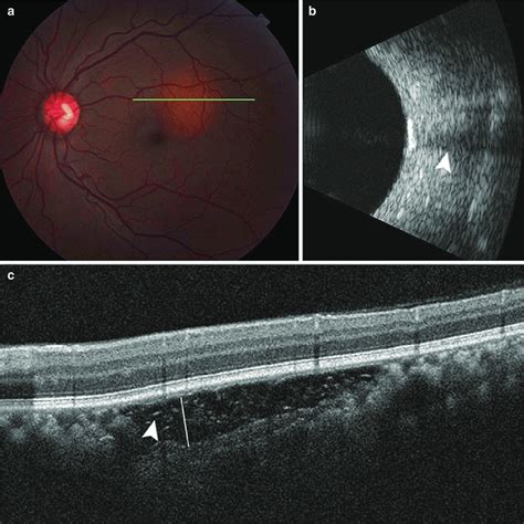 11 Choroidal Osteoma The Color Fundus Photograph Reveals The