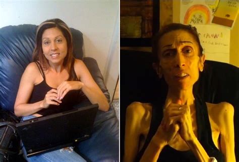 Atriz Com Anorexia Que Chegou Aos 19 Kg Agradece Doações Via Web “me
