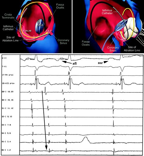 Atrial Flutter Ablation
