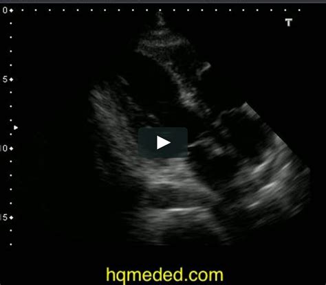 Hyperdynamic Heart On Vimeo