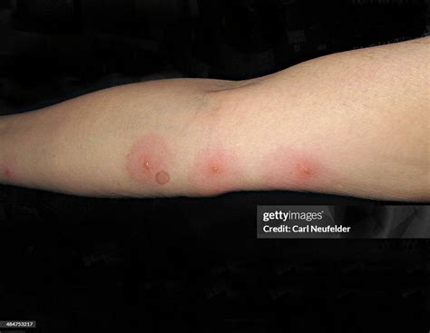 Bed Bug Bite Blisters Stock Foto Getty Images