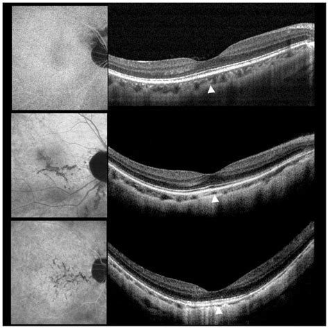 Pdf Choroidal Thickness And Biometric Markers For The Screening Of