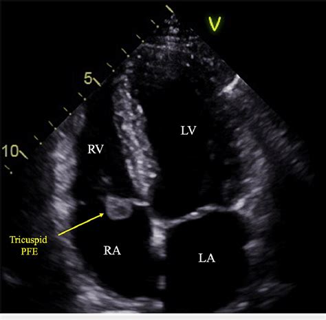 Apical Four Chamber View On Echocardiography Visualizing A Mass On The Download Scientific