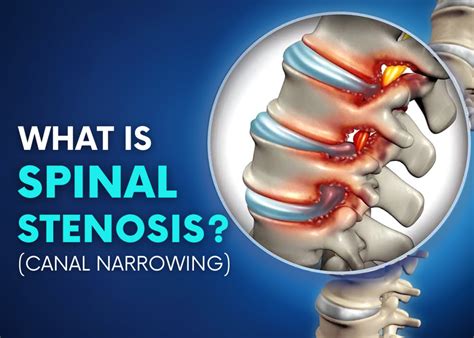 What Is Spinal Stenosis Turanandturan