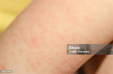 Sakit Dermatitis Ruam Alergi Tekstur Kulit Eksim Foto Stok Unduh