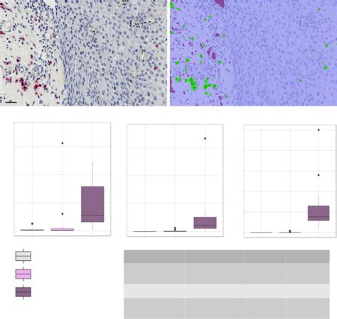 Oeosinophil Analysis A Oeosinophil Cationic Protein Ecp Staining In
