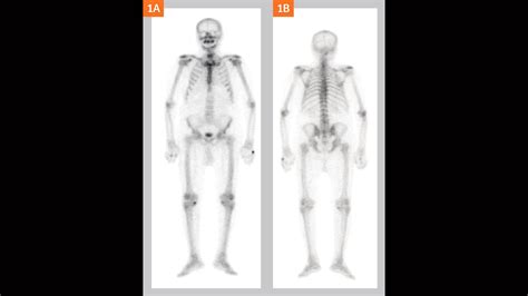 Bone Scintigraphy Imaging The Impact Of Adding Spect Ct Facility