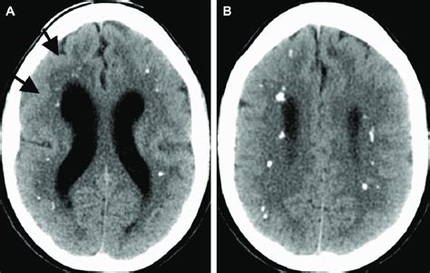 Congenital Toxoplasmosis Calcifications