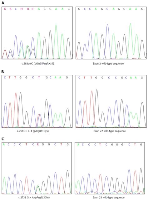 New Slc12a3 Disease Causative Mutation Of Gitelmans Syndrome Pmc
