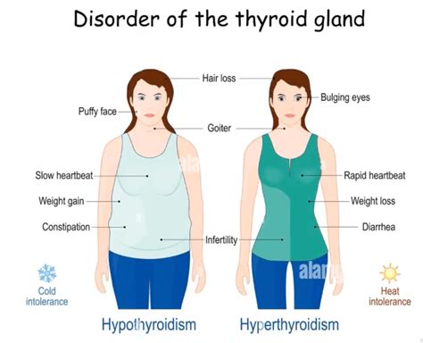 Thyroiditis Treatments Causes Symptoms Natural Treatment Wavwatch
