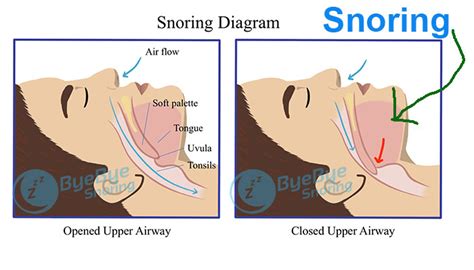 Whats The Difference Between Sleep Apnea And Snoring