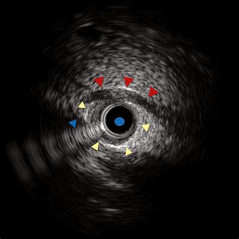 Intravascular Ultrasound Ivus Picture Of An Echo‐lucent Half‐moon