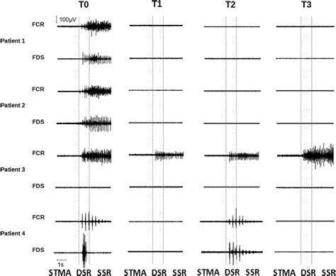 Emg Activity Of Flexor Carpi Radialis Fcr And Flexor Digitorum Download Scientific Diagram