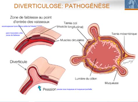 Diverticulose Flashcards Quizlet