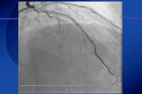 Part Ecg Stemi Nstemi 2019 Ppt Heart And Cardiovascular Diseases