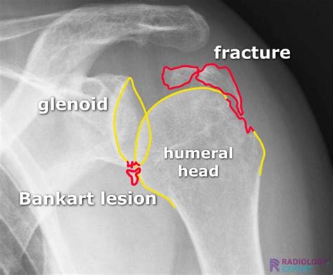 Fractured Shoulder X Ray