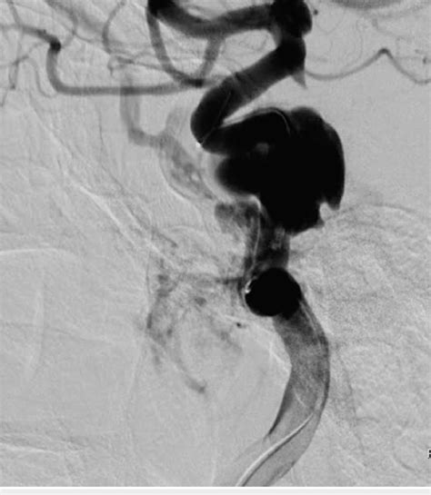 Magnify Images In Lateral Projection At Dsa Wall Defect And