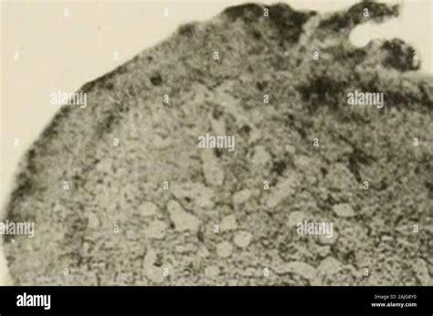Transactions Plate 2 Polypoid Angiomia Of The Ear Richards