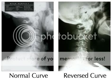 What Does A Reversed Cervical Curve Look Like A Chiropractor S Opinion