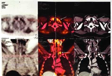 18f Choline Petct Scan Shows Enlarged Supraclavicular Lymph Node In