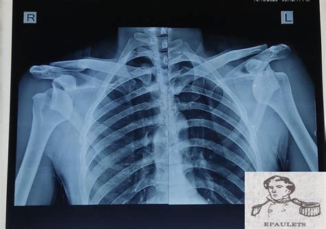 Simultaneous Bilateral Anterior Shoulder Dislocation Following