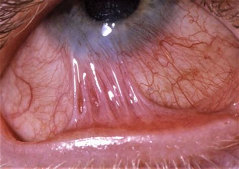 Symblepharon Prognosis Optography