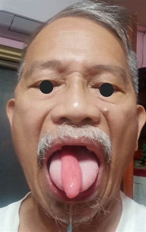 63‐year‐old Male With A Pedunculated Smooth Mass Protruding Outside The