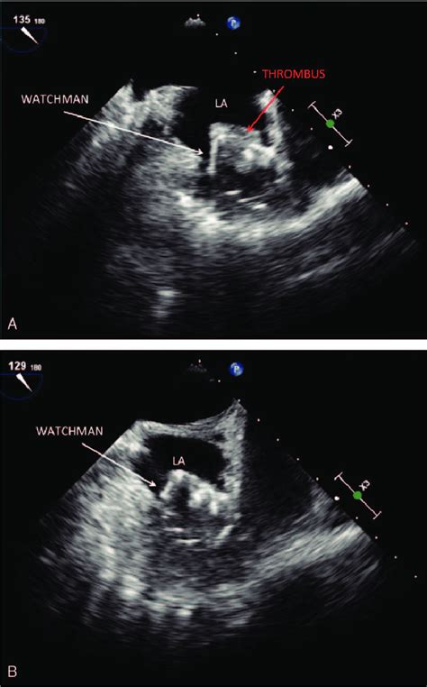 A Transesophageal Echocardiographic Image Showing A Layer Of