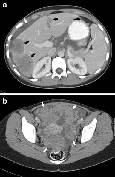 A Calcification Was Seen Within The Soft Tissue Lesions In 420 Cases