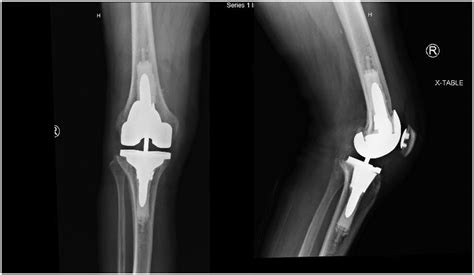Comment On Revision Total Knee Arthroplasty Using Robotic Arm