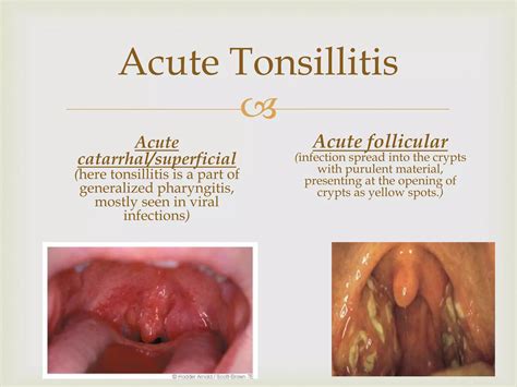 Tonsils Ppt Pptx