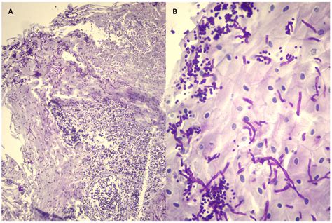 Gastric Candidiasis In Five Horses A Case Series