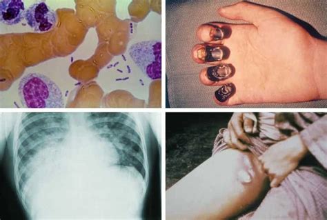 Understanding Plague And Other Infections Causes Symptoms And Prevention