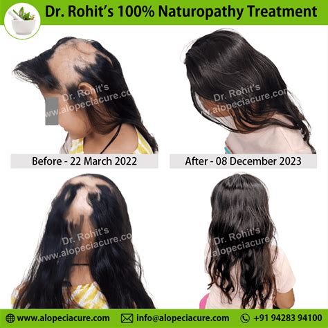 Ophiasis Alopecia Areata Treatment